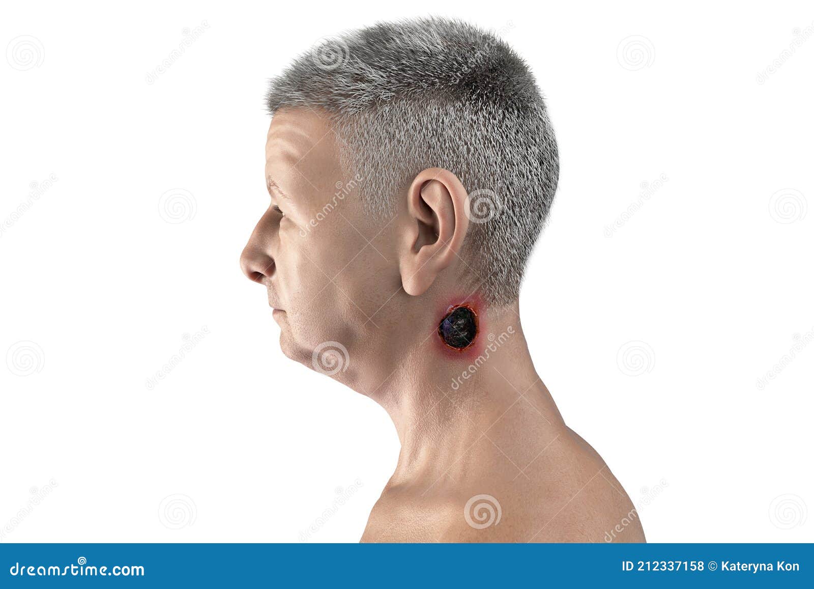 Cutaneous Anthrax, the Most Common Form of Anthrax Stock Illustration ...