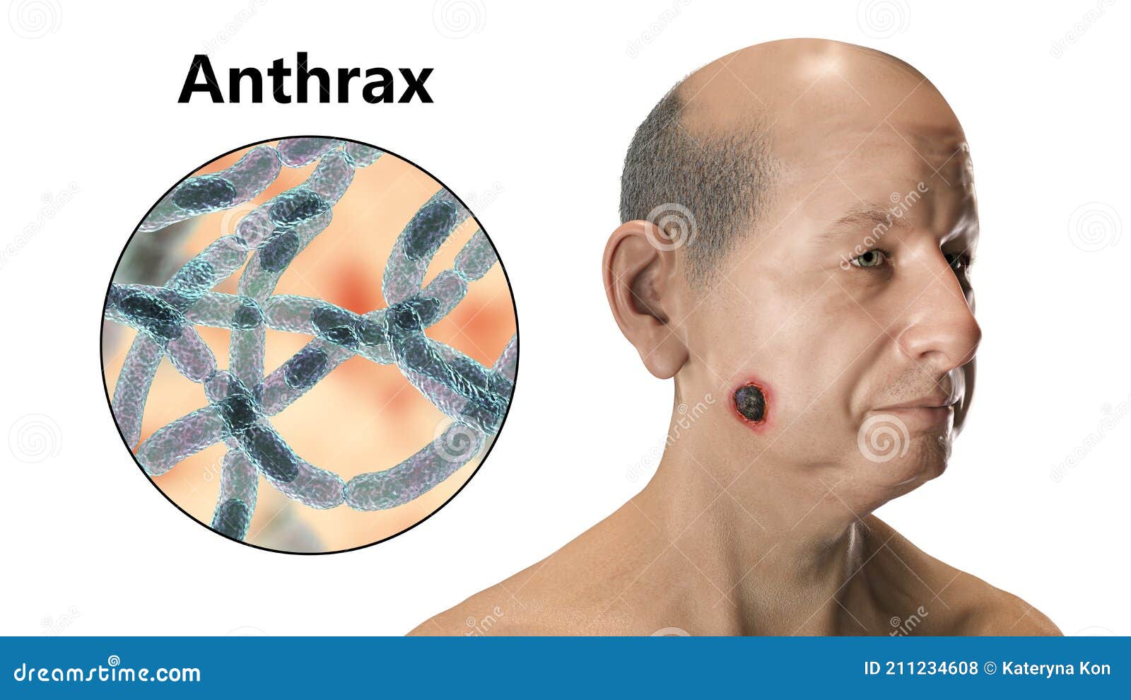 Cutaneous Anthrax The Most Common Form Of Anthrax Stock Illustration Illustration Of