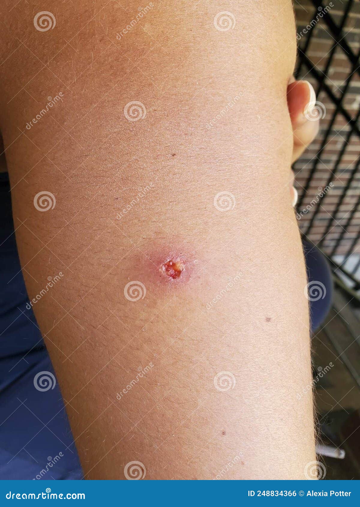 Cutaneous Skin Lesion stock photo. Image of sores, lesion - 248834366