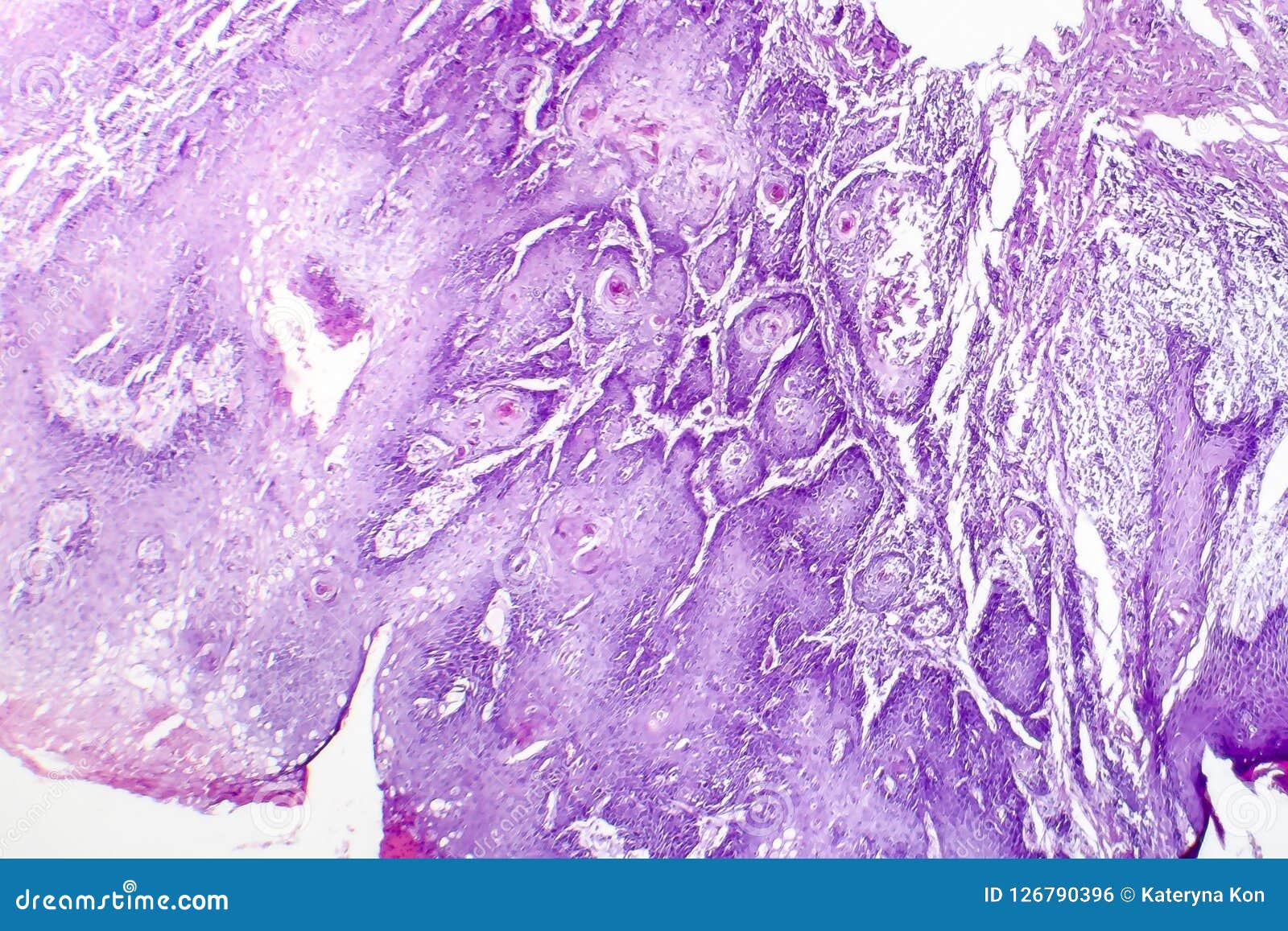 Cutaneous Squamous Cell Carcinoma Stock Photo - Image of cutaneous ...