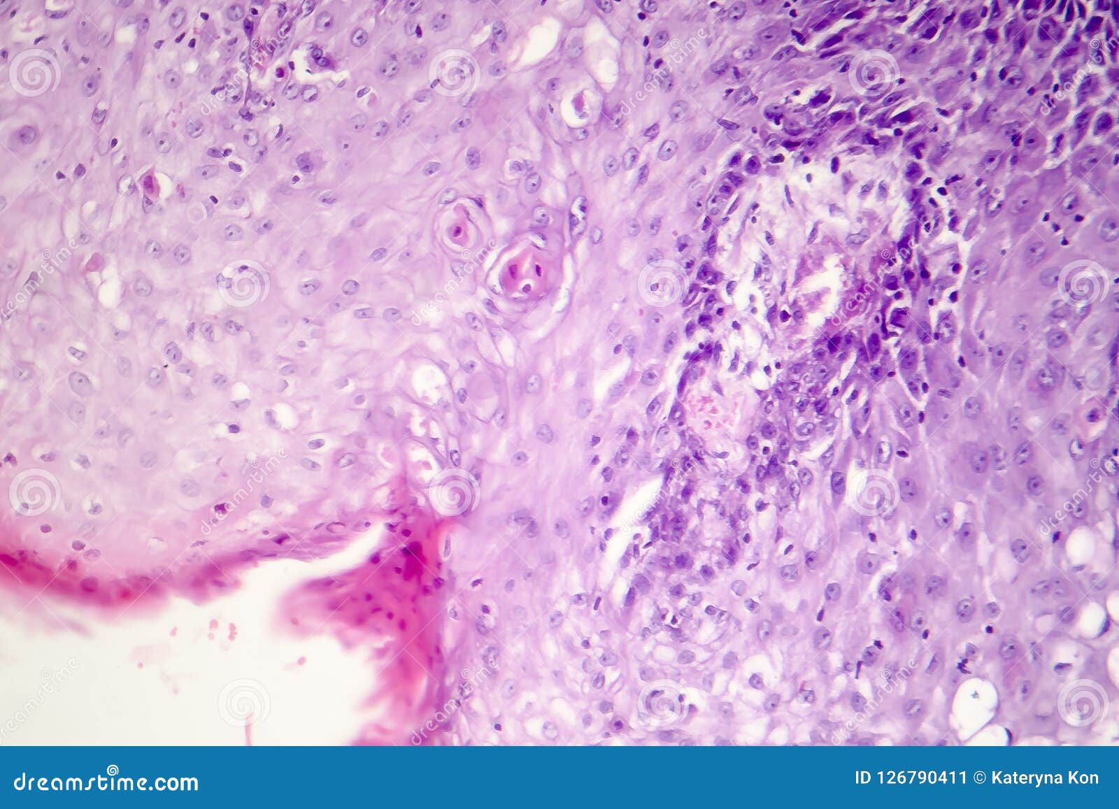 Cutaneous Squamous Cell Carcinoma Stock Image - Image of carcinoma ...