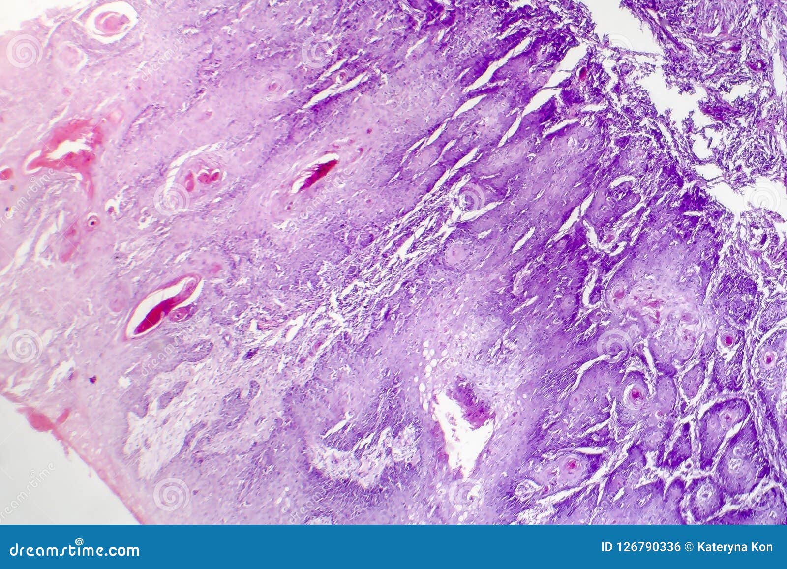 Cutaneous Squamous Cell Carcinoma Stock Photo - Image of medicine, skin ...