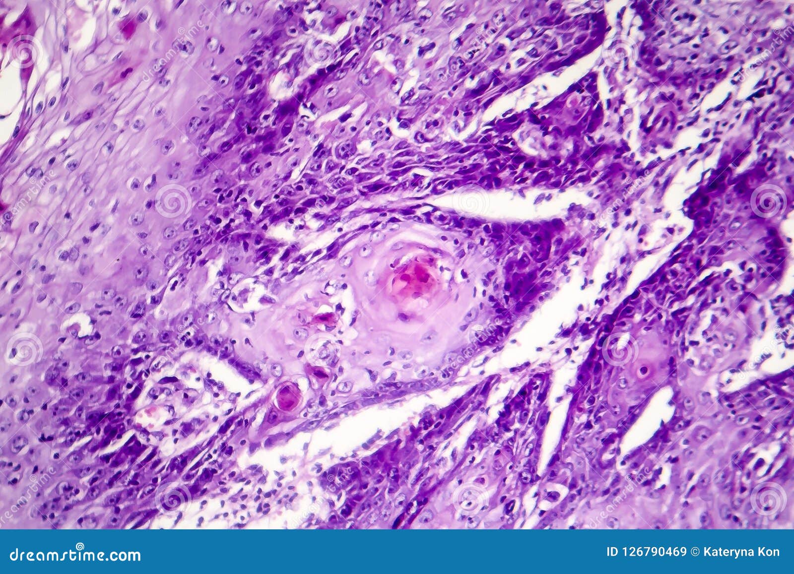 Cutaneous Squamous Cell Carcinoma Stock Image - Image of epithelial ...