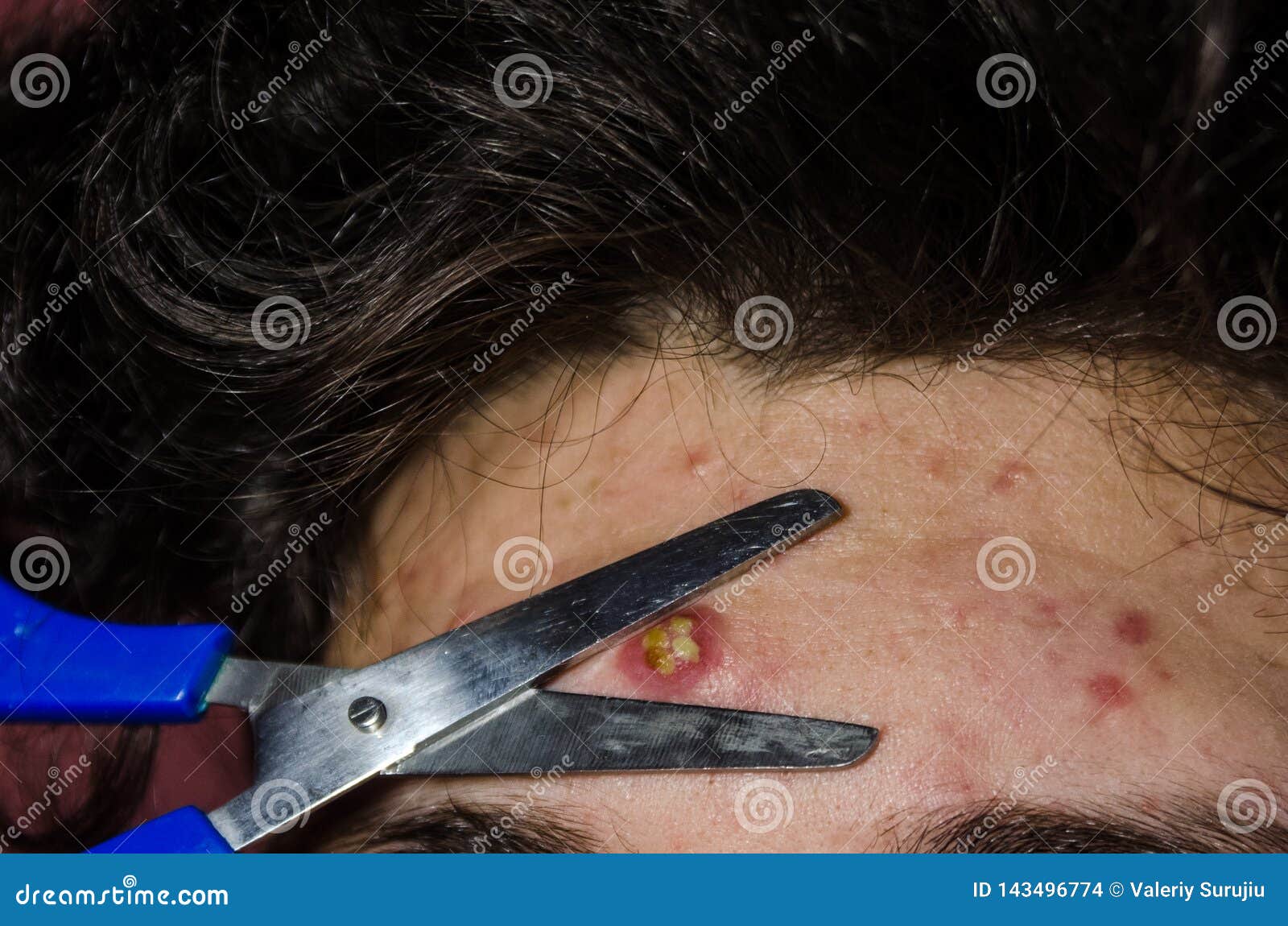 Cutting Pimple with Scissors Stock Photo - Image of looking, girl ...