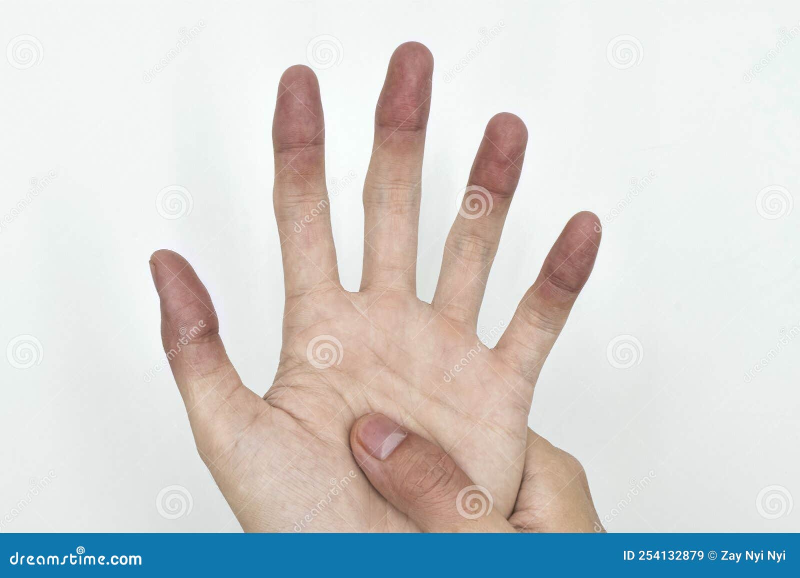 Cyanotic Hands or Peripheral Cyanosis or Blue Hands at Asian Man Stock ... Cyanotic Hands or Peripheral Cyanosis or Blue Hands at Asian Man Stock ...