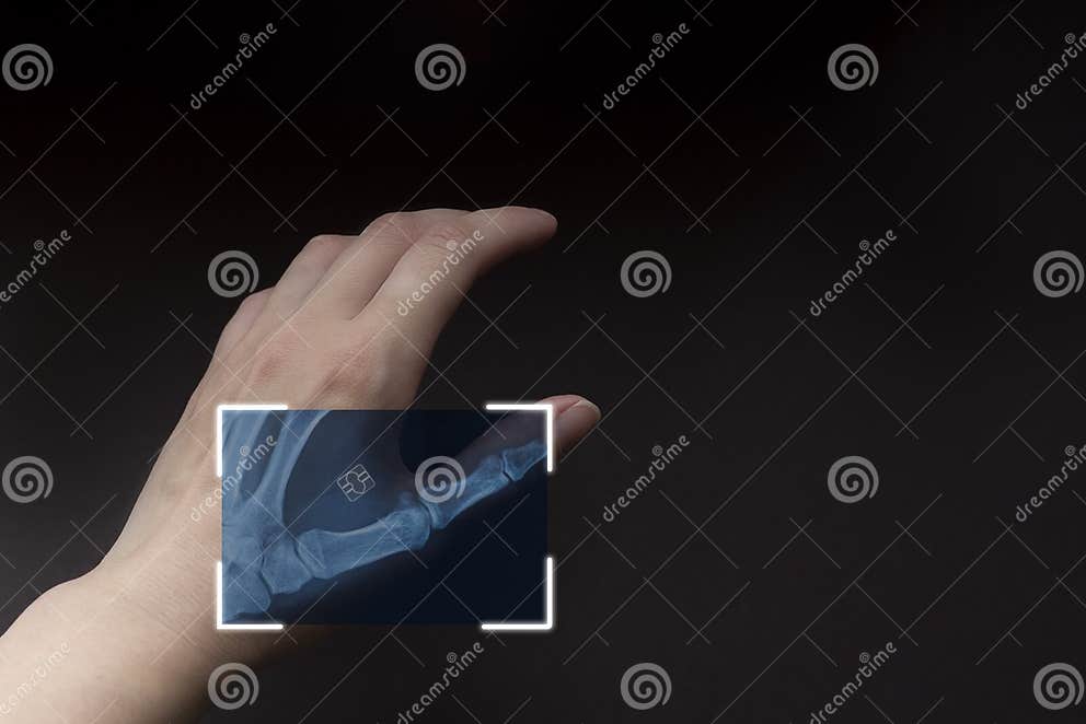 Microchip Under the Skin in an X-ray. People Chipping Concept. Spying ...