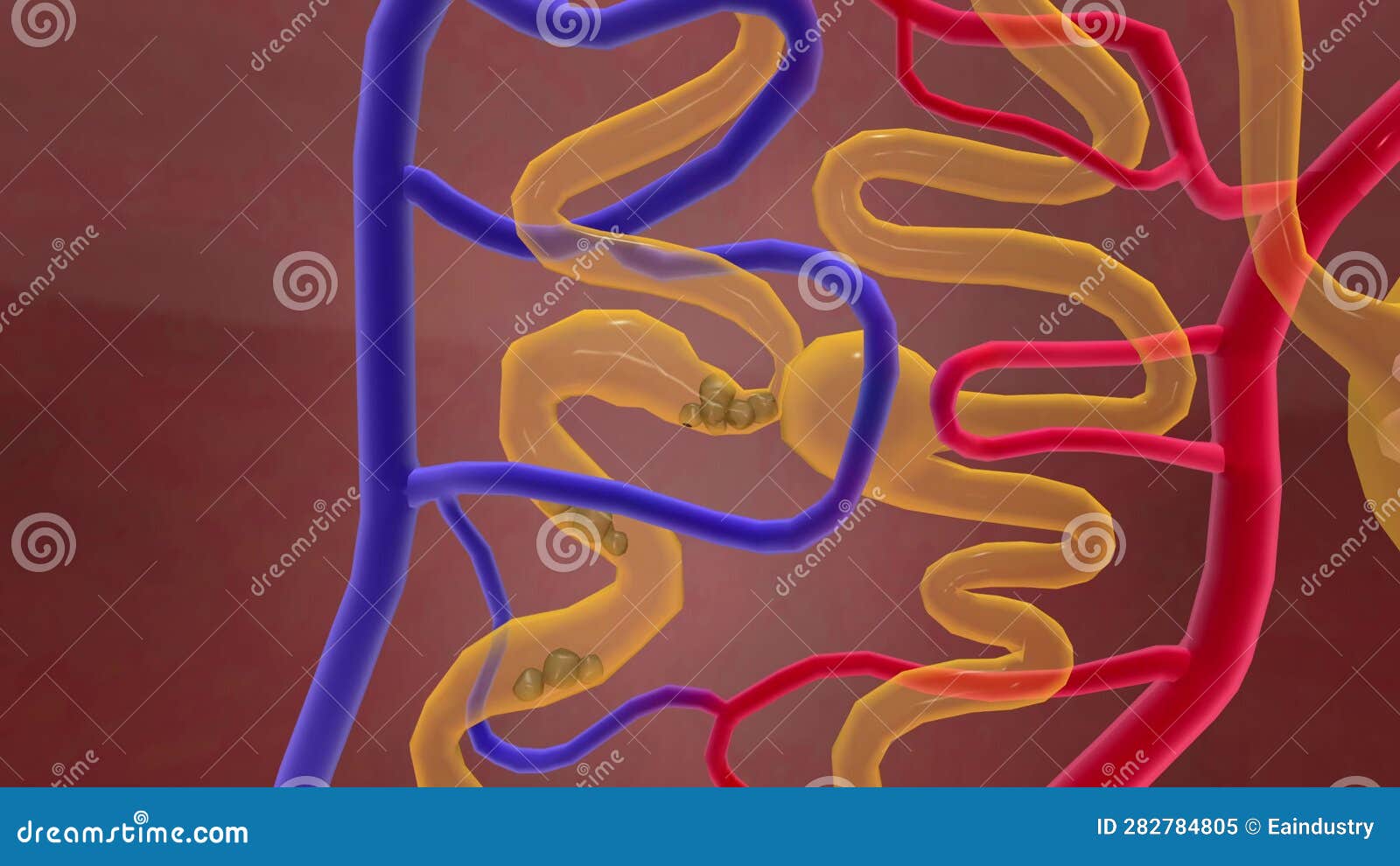 Cyst Obstructing Artery Urinary Stasis Causing Kidney Stones Stock ...