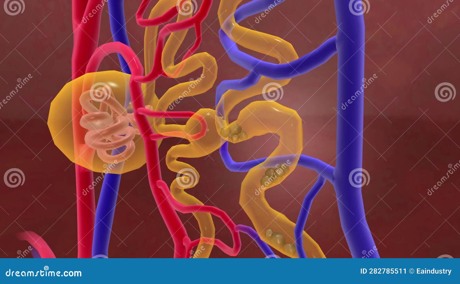 Cyst Obstructing Artery Urinary Stasis Causing Kidney Stones Stock ...