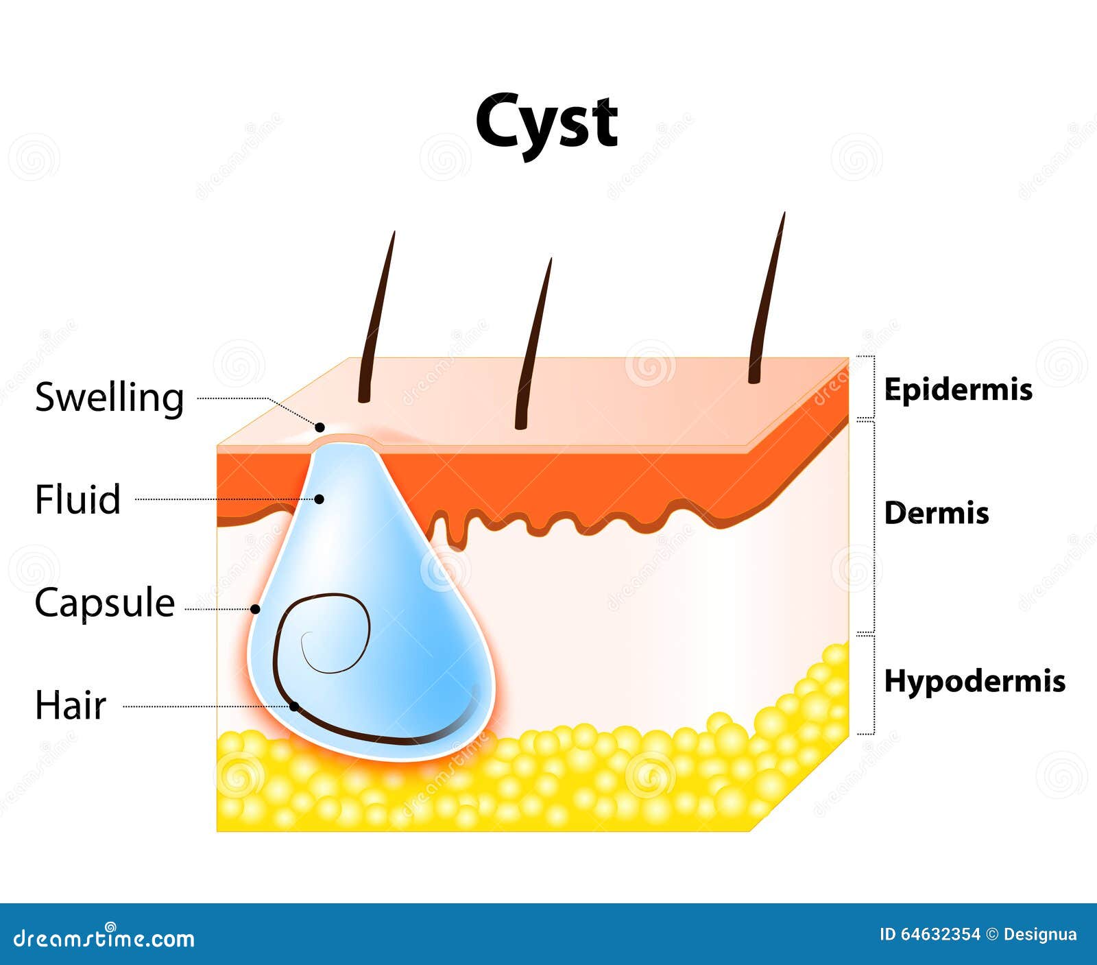 Cyste vector illustratie. Illustration of besmet, ziekte - 64632354