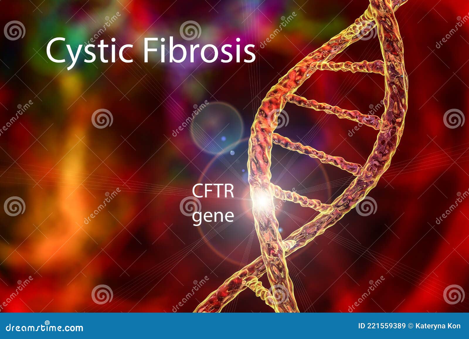 Cystic Fibrosis A Genetic Disorder Caused By Mutation In The Cftr Gene