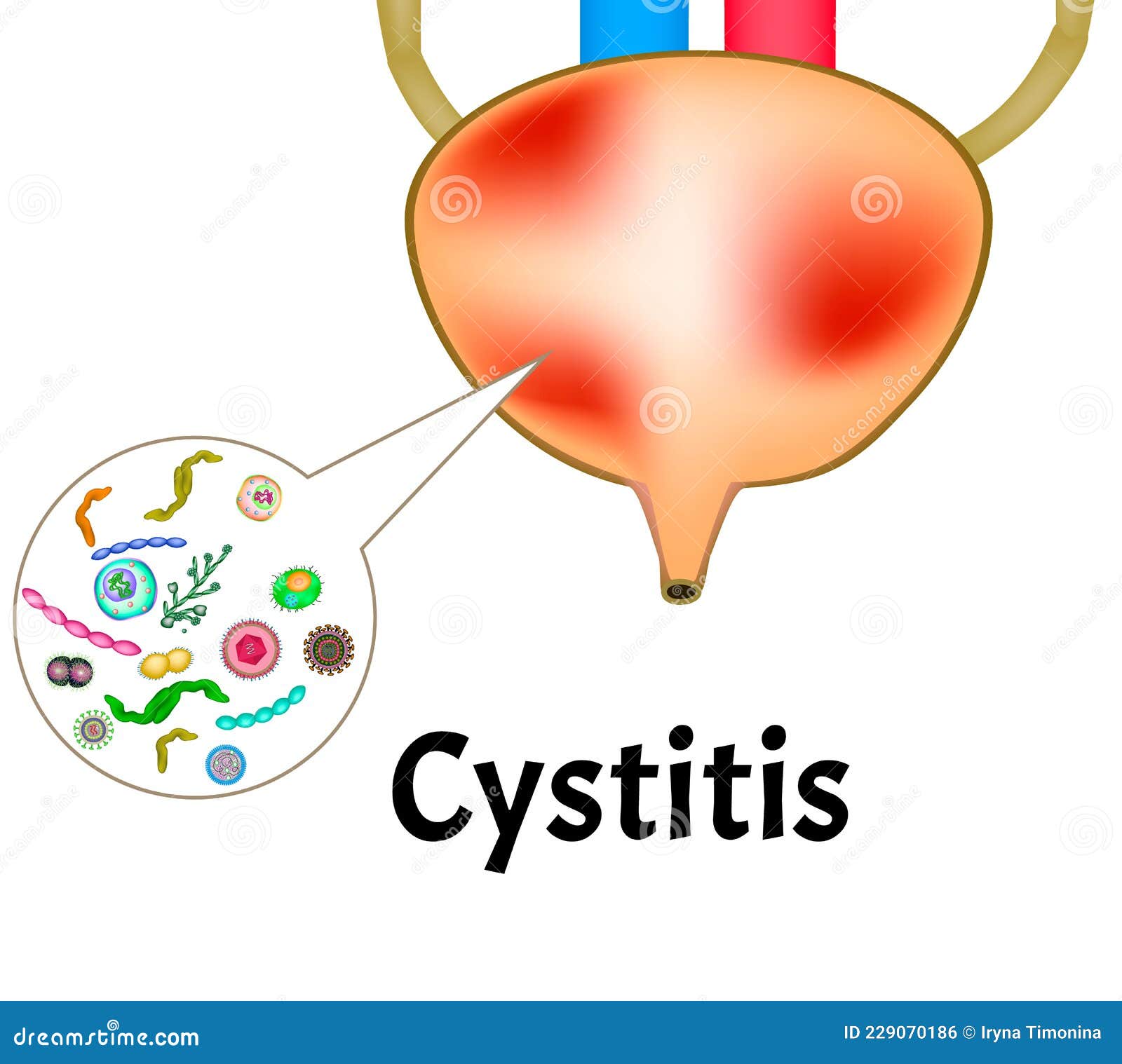 Cystitis. Inflammation of the Bladder. the Structure of the Kidneys and ...