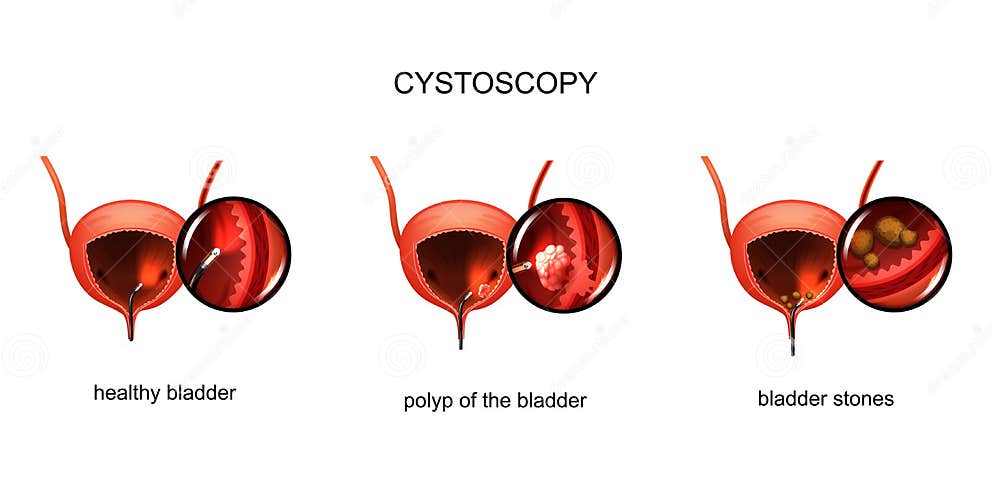 Cystoscopy of the Bladder. Stones and Polyp. Stock Vector ...