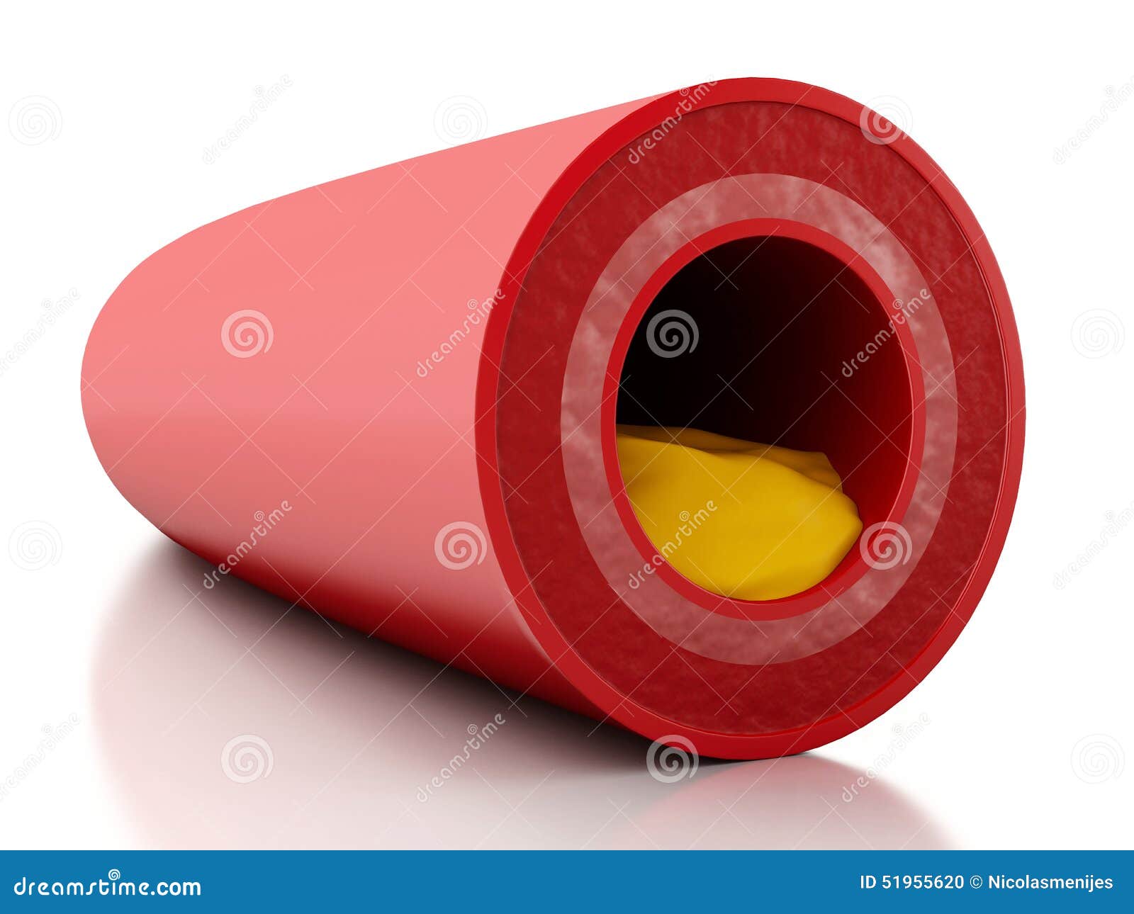 3d Cholesterol Plaque in Artery. Stock Illustration - Illustration of ...