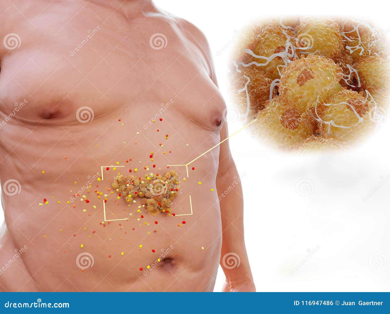 Adipocytes, Obesity, And Inflammation. Normal, And Obese Adipose Tissue ... Adipocytes, Obesity, And Inflammation. Normal, And Obese Adipose Tissue ...