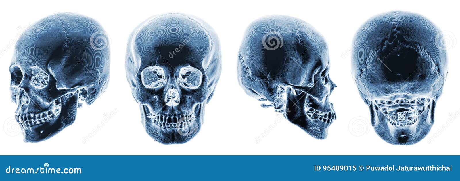 3D CT Scan Of Human Skull . Multiple View . Invert Color Style Royalty ...