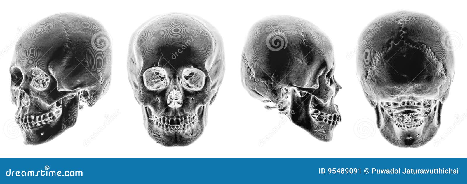 Human Skull On Clear Blue Background. Open Skull Without Lower Jaw ...