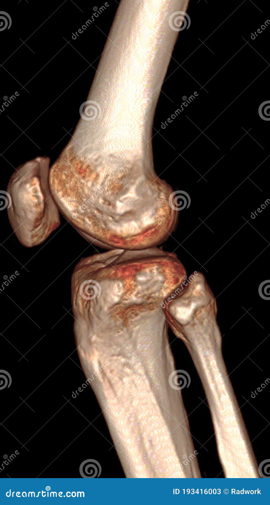 3D CT Volume Rendering Knee Stock Illustration - Illustration of ...