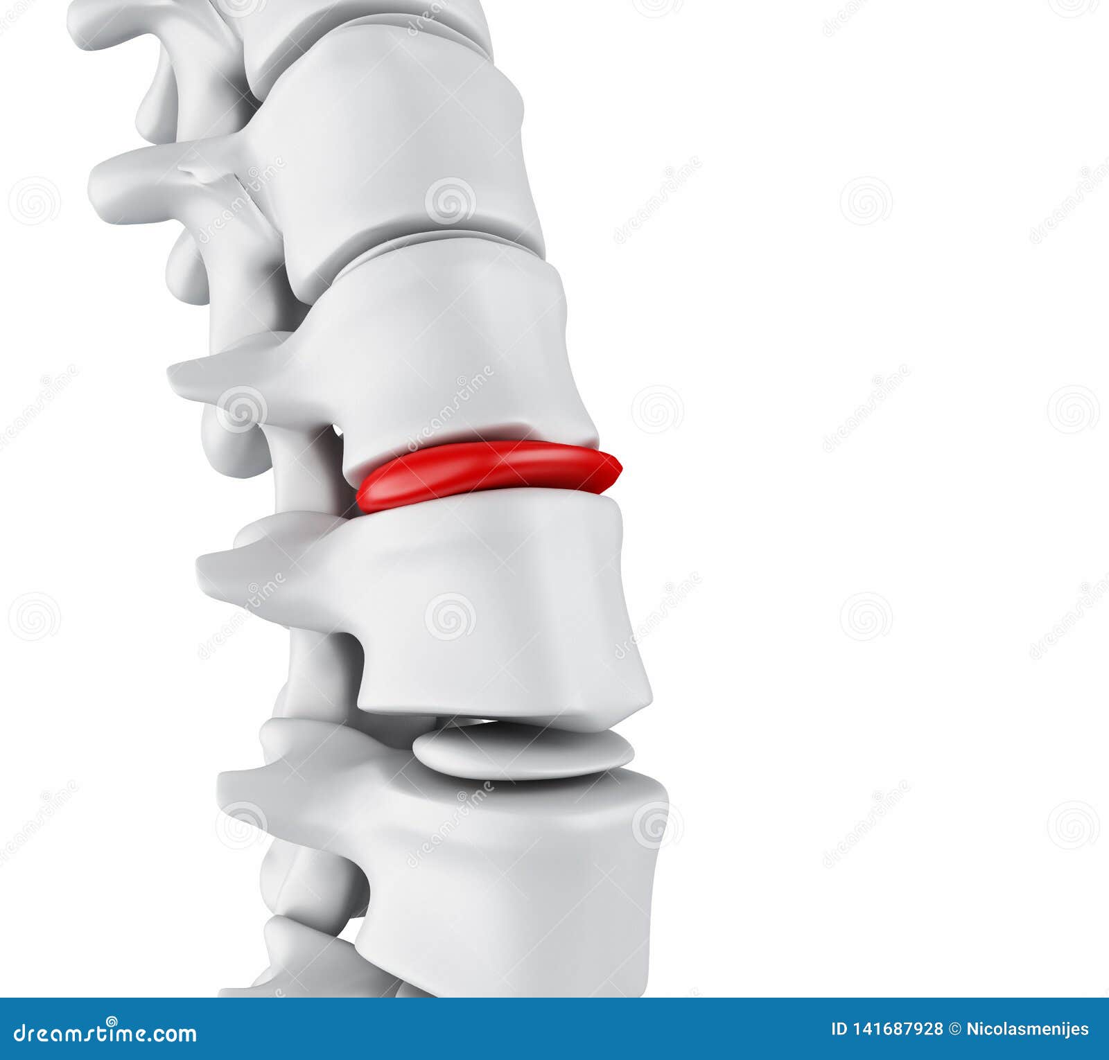 3d Herniated disk concept stock illustration. Illustration of pain ...