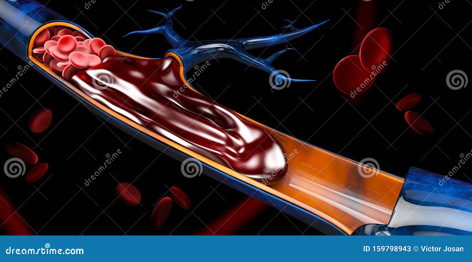 3d Illustration of Deep Vein Thrombosis or Blood Clots. Embolism Stock ...