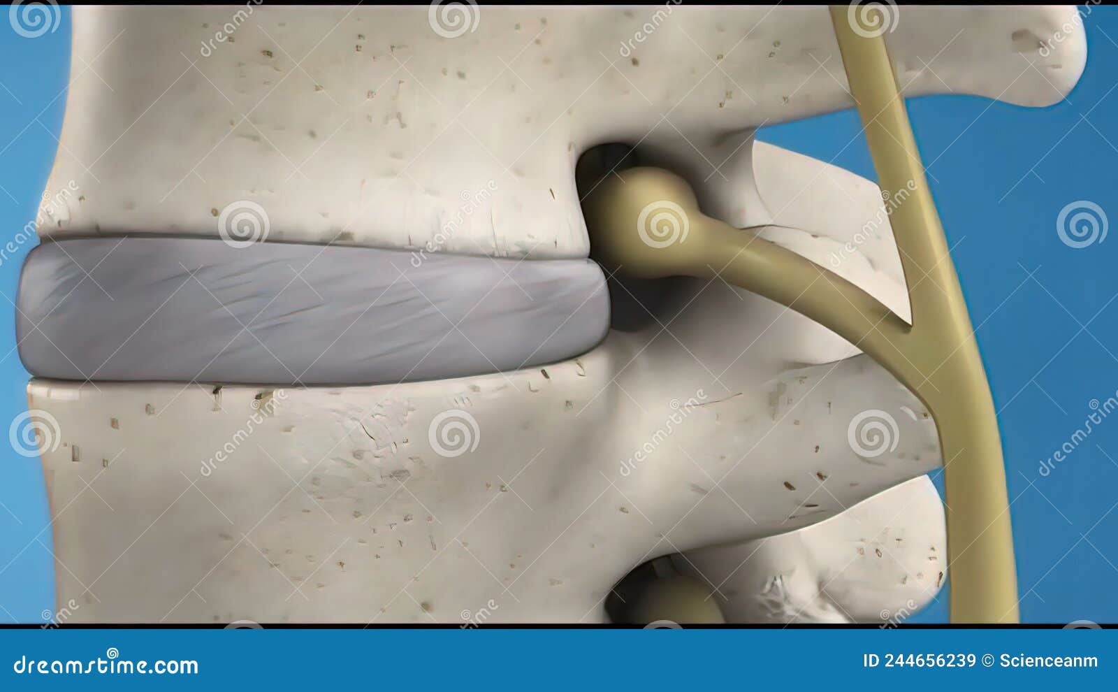 3D Illustration of the Destruction of Discs and Compression of Nerve ...