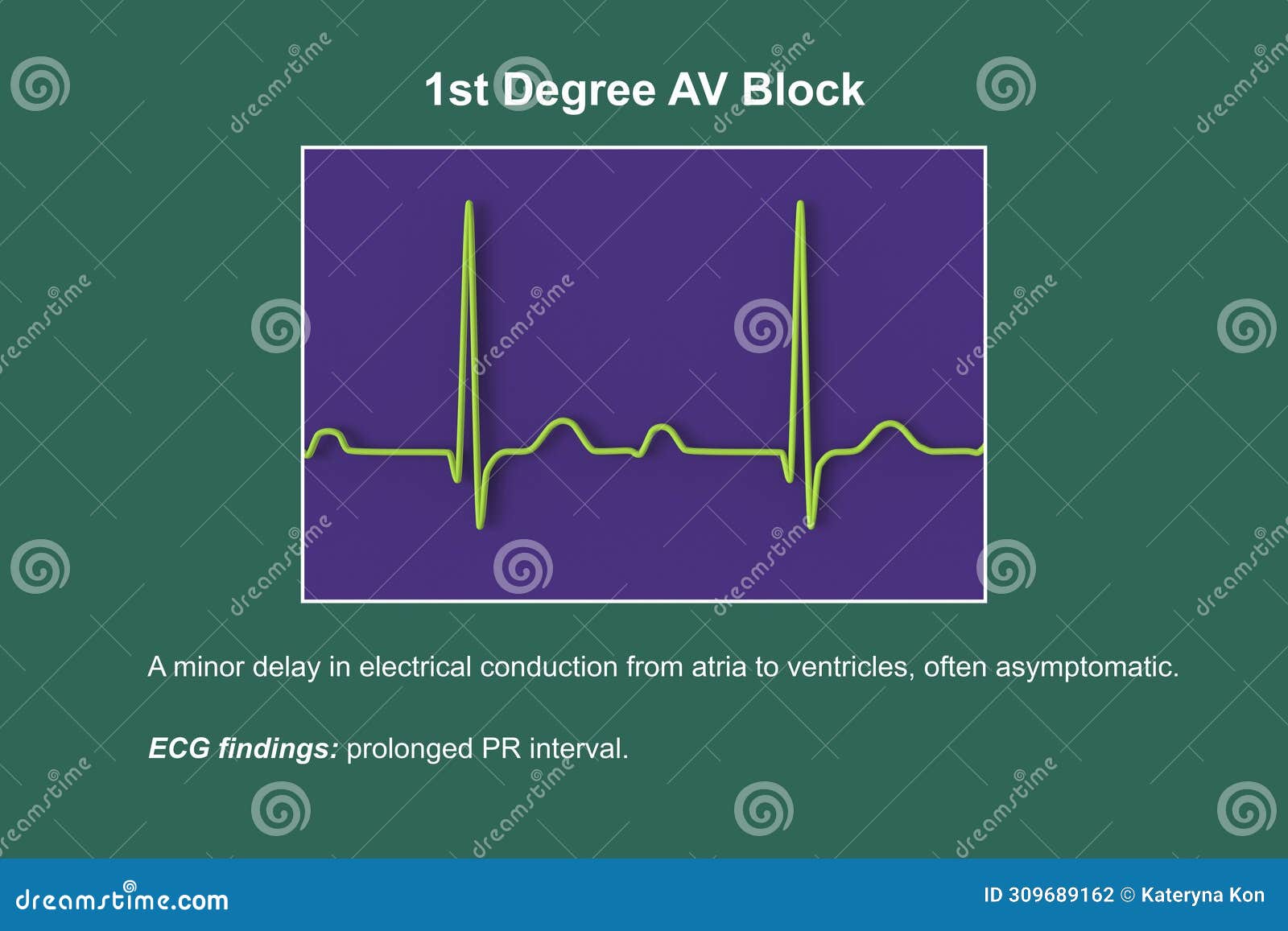 Ecg Of 1st Degree Av Block 3d Illustration Stock Illustration Illustration Of Function Rate