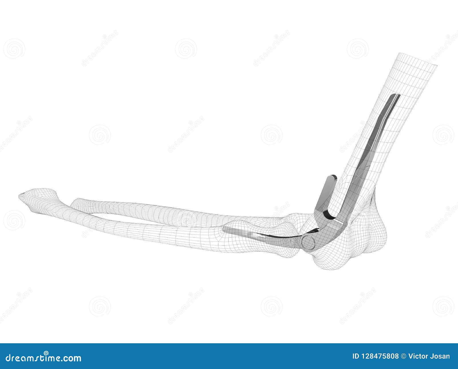 3d Illustration of the Endoprosthesis of the Elbow Joint Stock ...