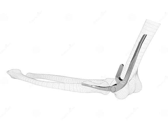 3d Illustration of the Endoprosthesis of the Elbow Joint Stock ...