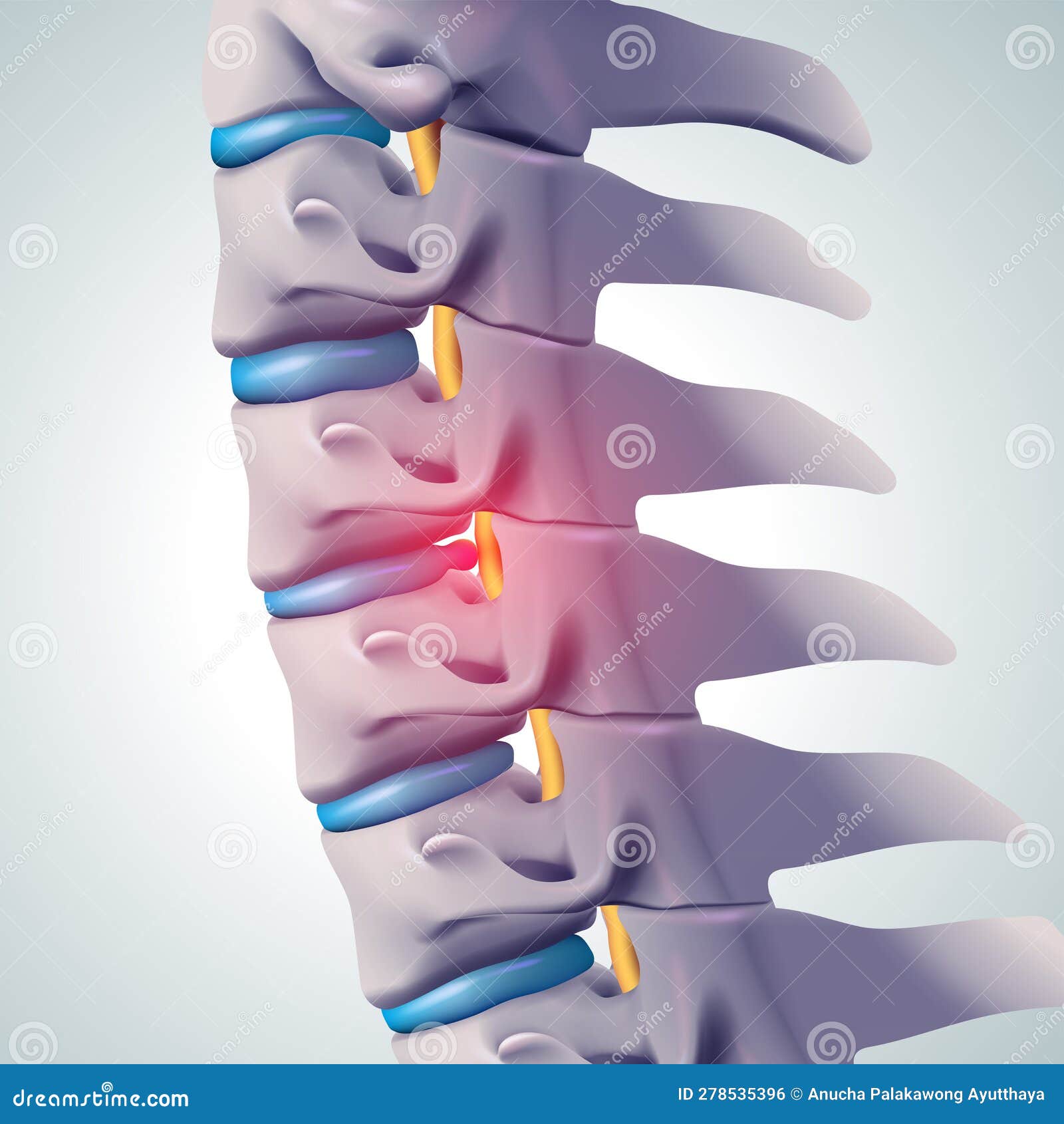 3D Illustration. Herniated Discs Press on Nerves Causing Pain Stock ...