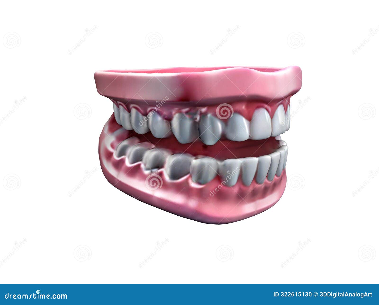 Dentition On The Gum. Teeth With Dental Implant Cartoon In Flat Design ...