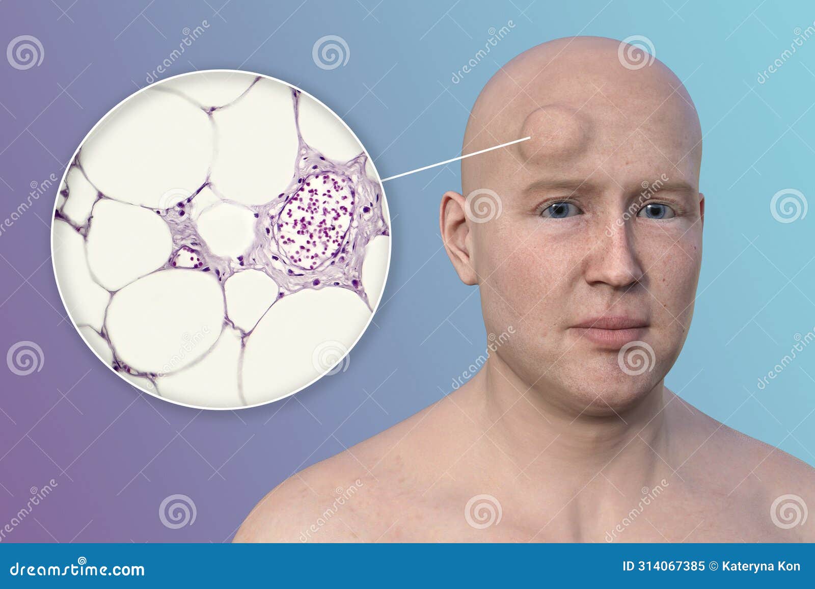 Lipoma on a Man S Forehead, 3D Illustration and Micrograph Stock ...