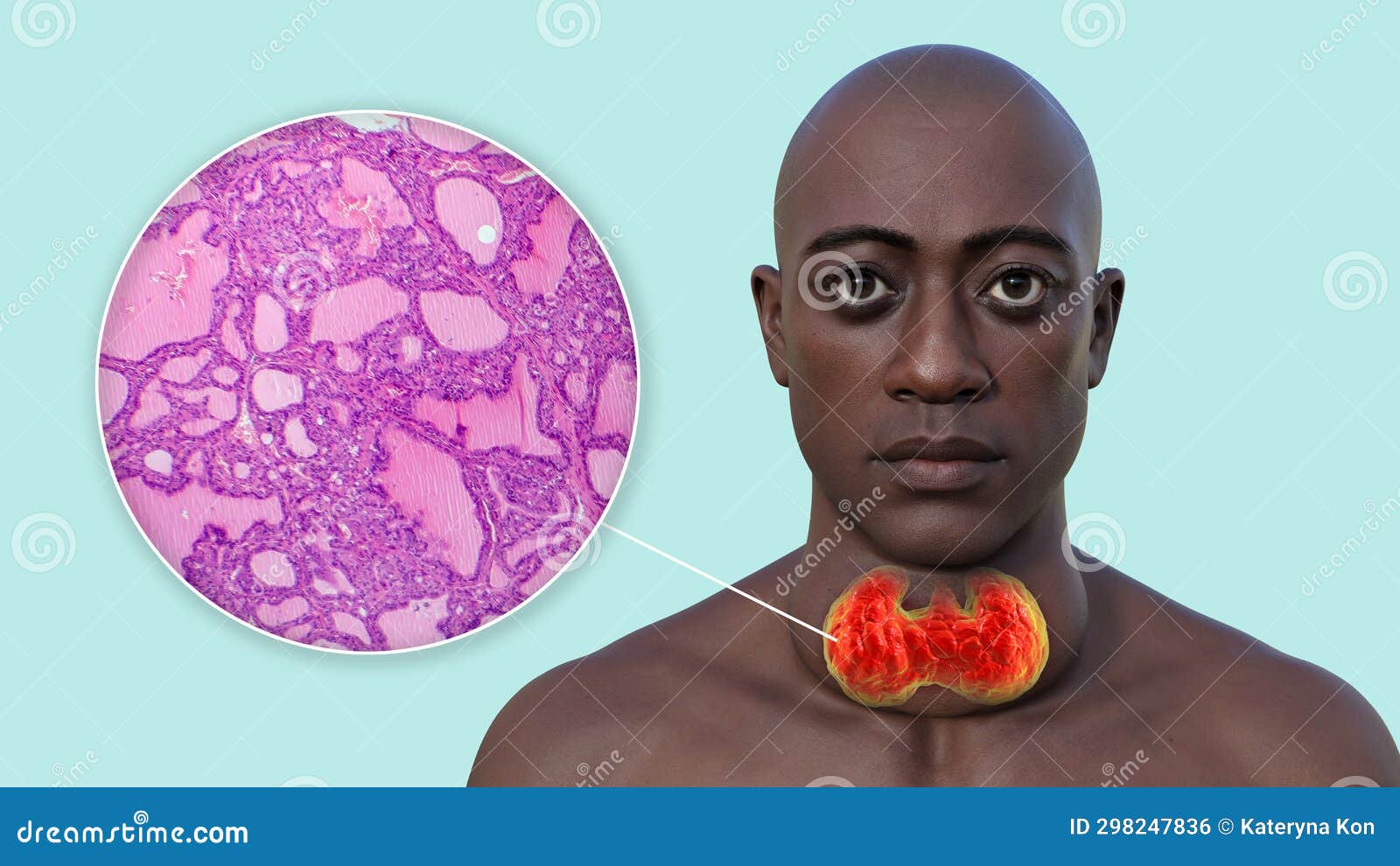 A Man with Enlarged Thyroid Gland, 3D Illustration, and Micrograph ...