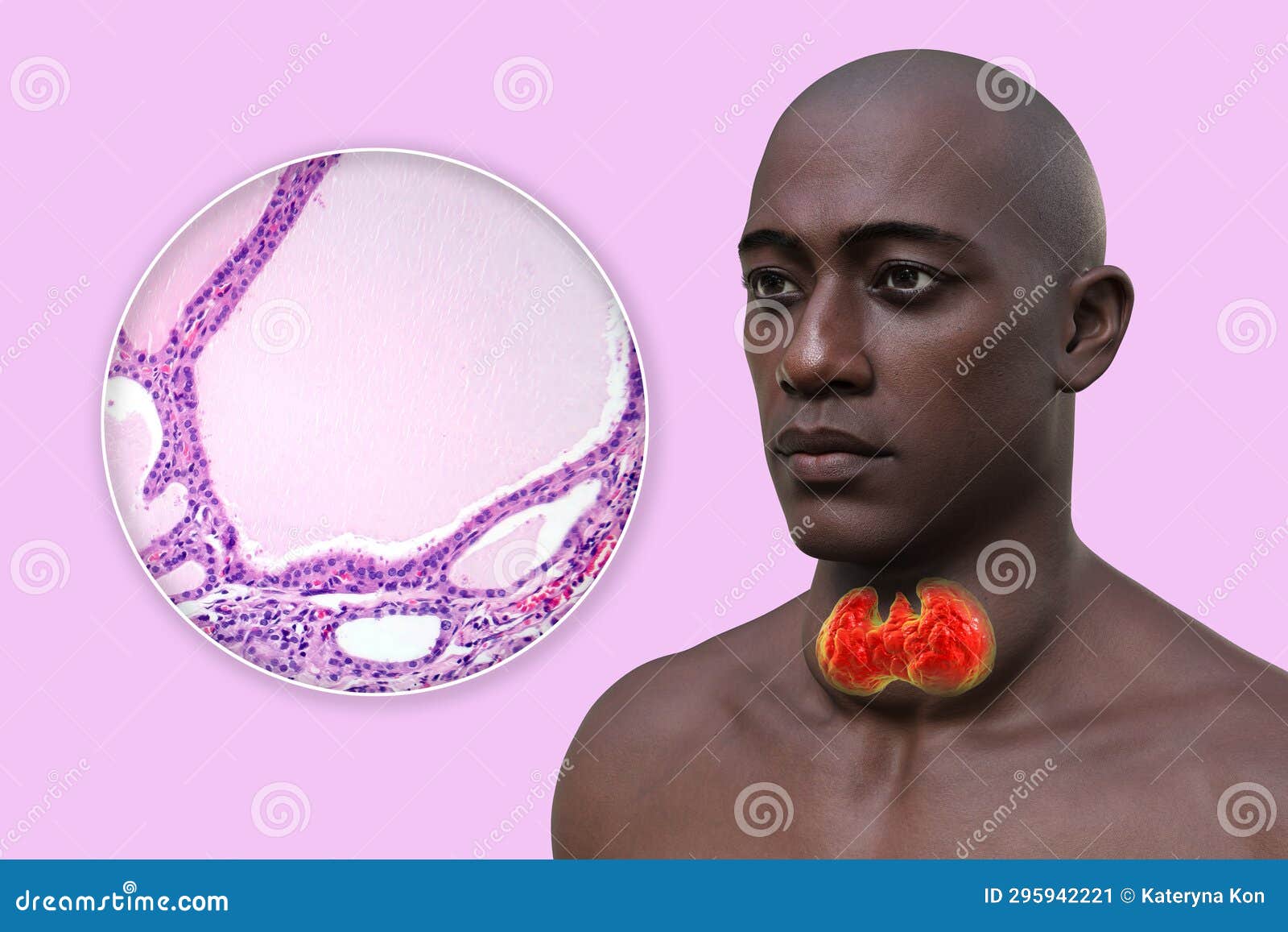 A Man with Enlarged Thyroid Gland, 3D Illustration, and Micrograph of ...