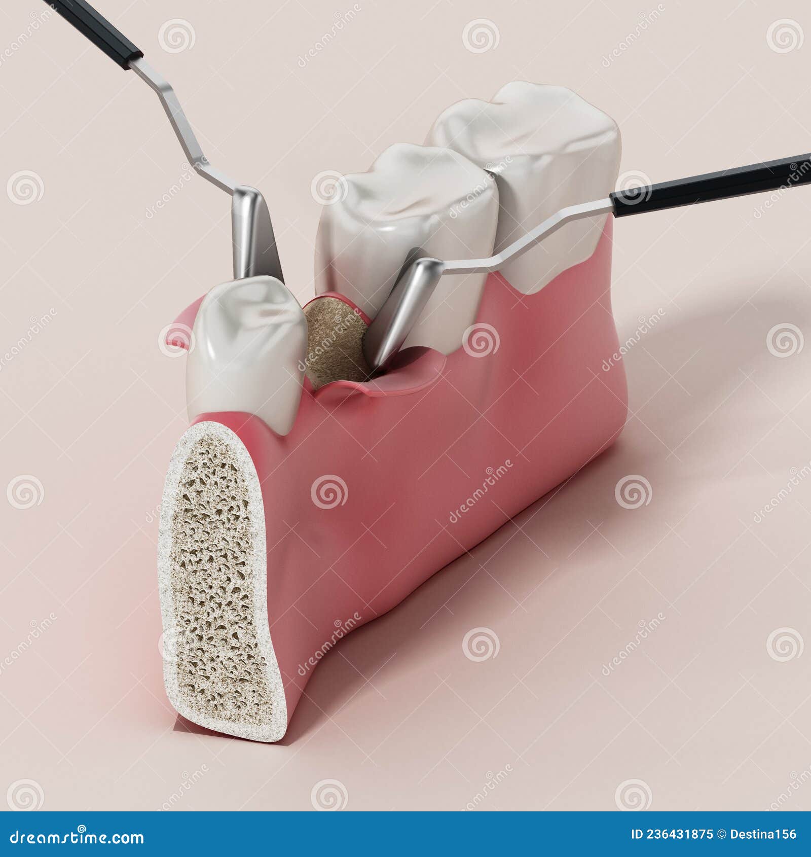 3D Illustration of Mid-crestal Incision Dental Operation. 3D ...