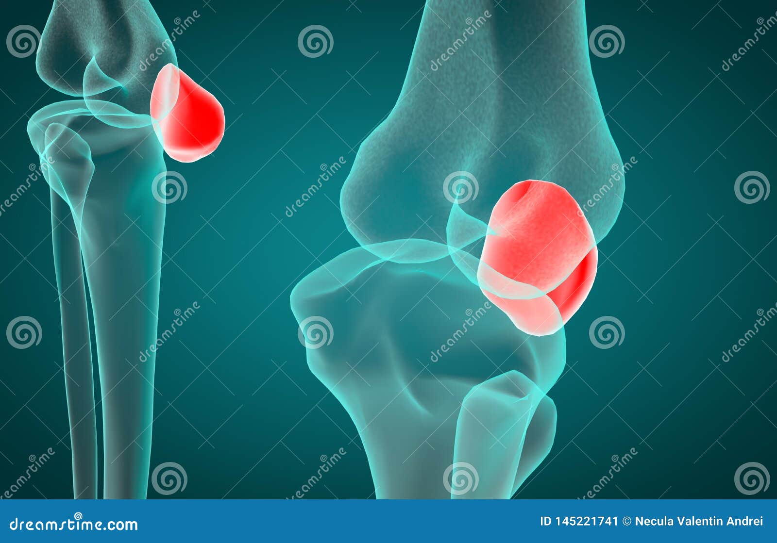 3D Illustration of Patella, Medical Concept Stock Illustration ...