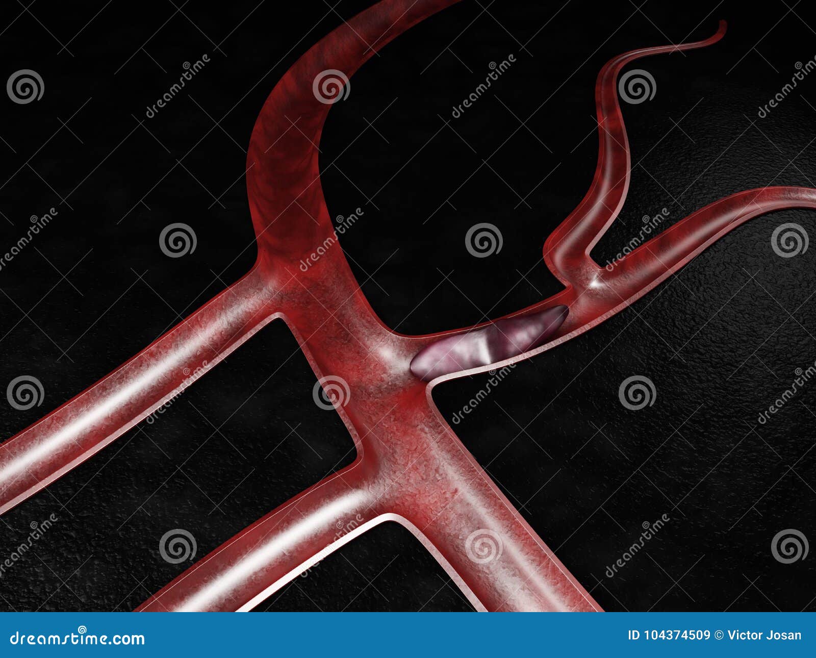 3d Illustration of Pulmonary Thromboembolism. Thrombosis of the Vessel ...