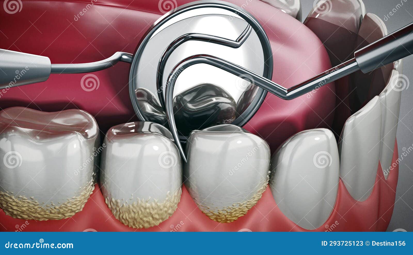 3D Illustration Showing Dentist Tools and Dental Plaque on Model. 3D ...