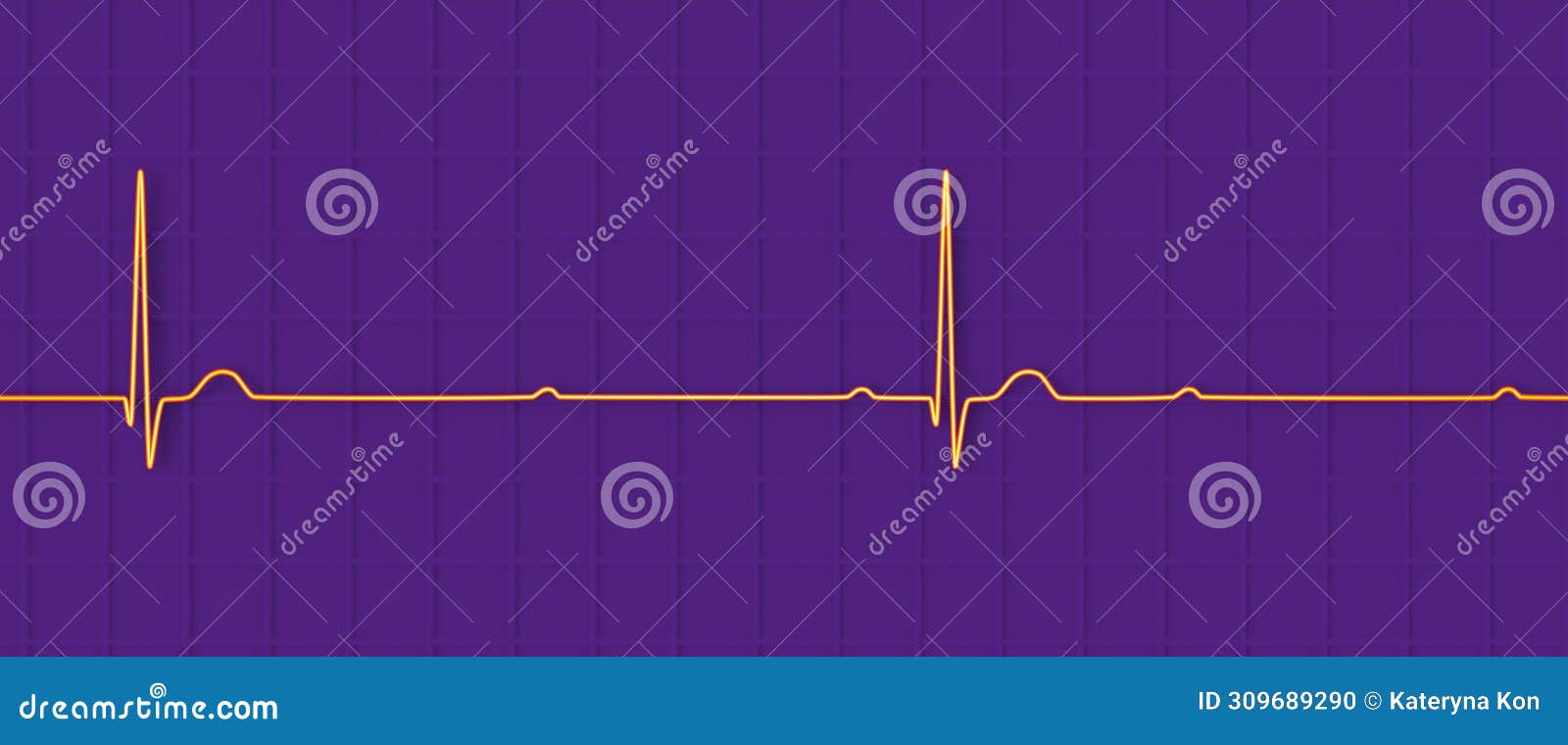 ECG of 3rd Degree AV Block, 3D Illustration Stock Illustration ...