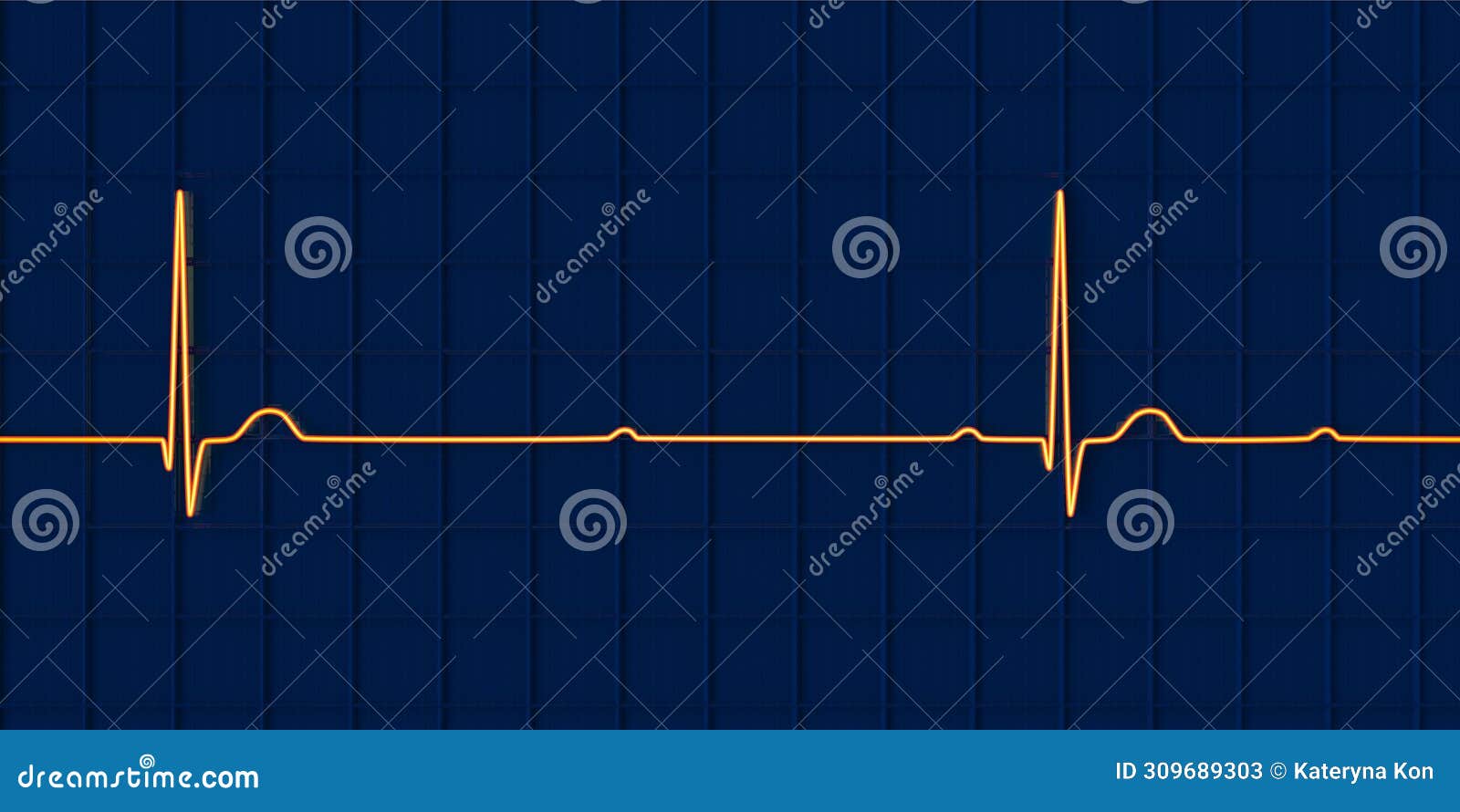 ECG of 3rd Degree AV Block, 3D Illustration Stock Illustration ...