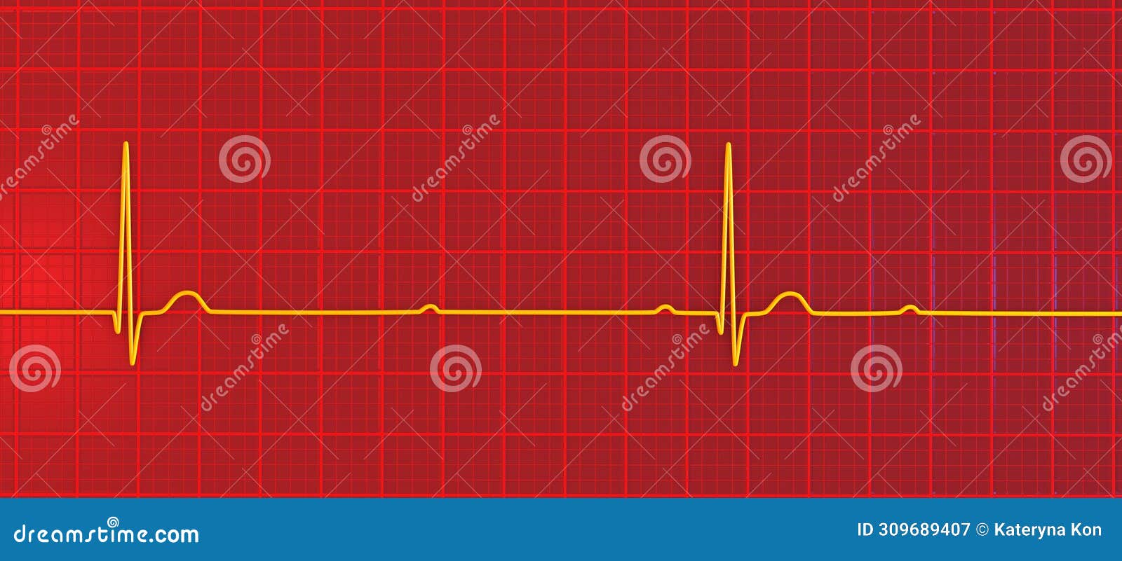 ECG of 3rd Degree AV Block, 3D Illustration Stock Illustration ...