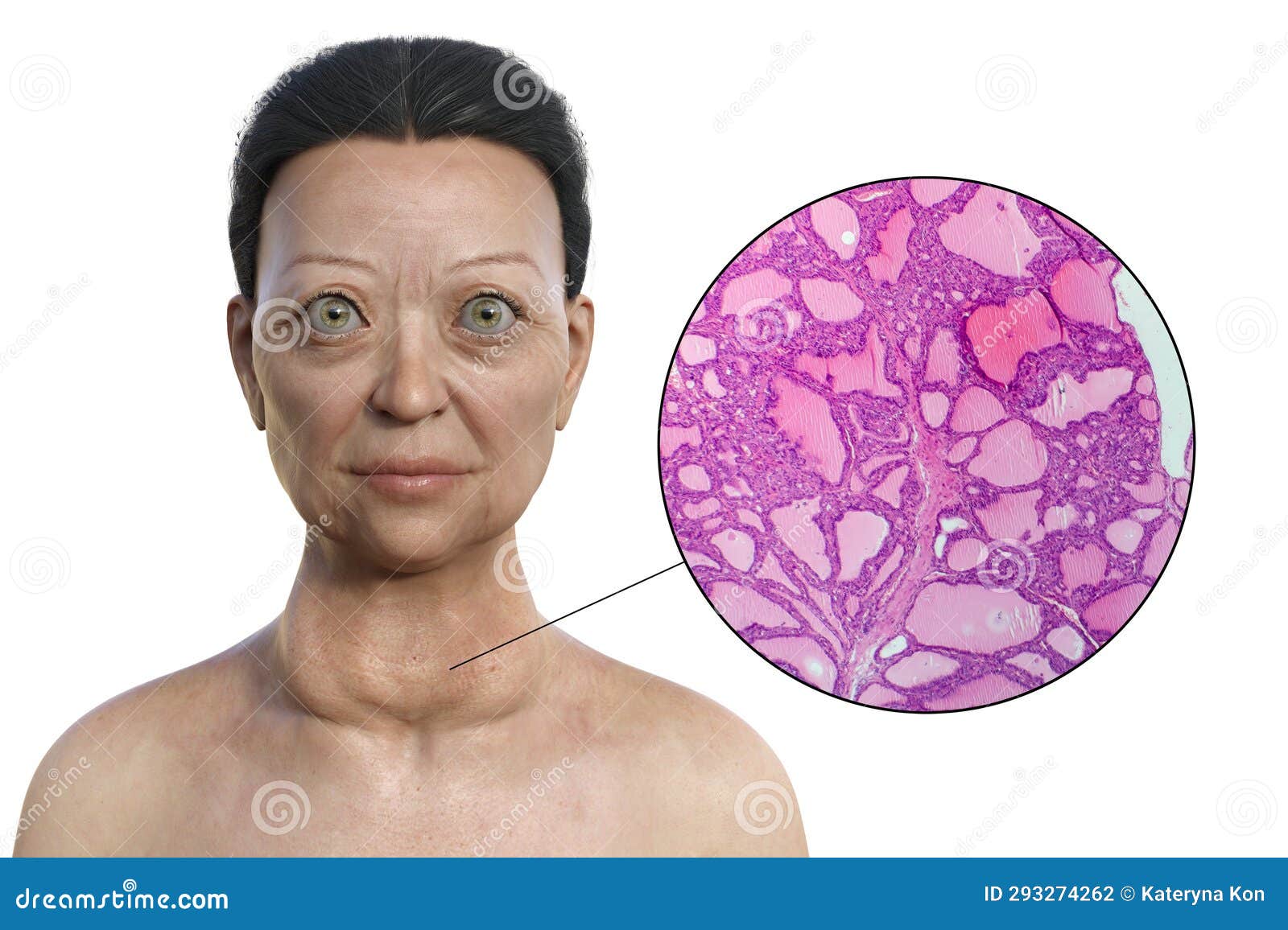 A 3d Illustration Of A Woman With Graves Disease Alongside A Micrograph