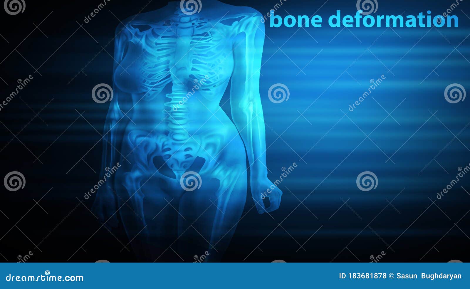 3d Illustration of a Woman`s Body Bone Deformation Stock Illustration ...