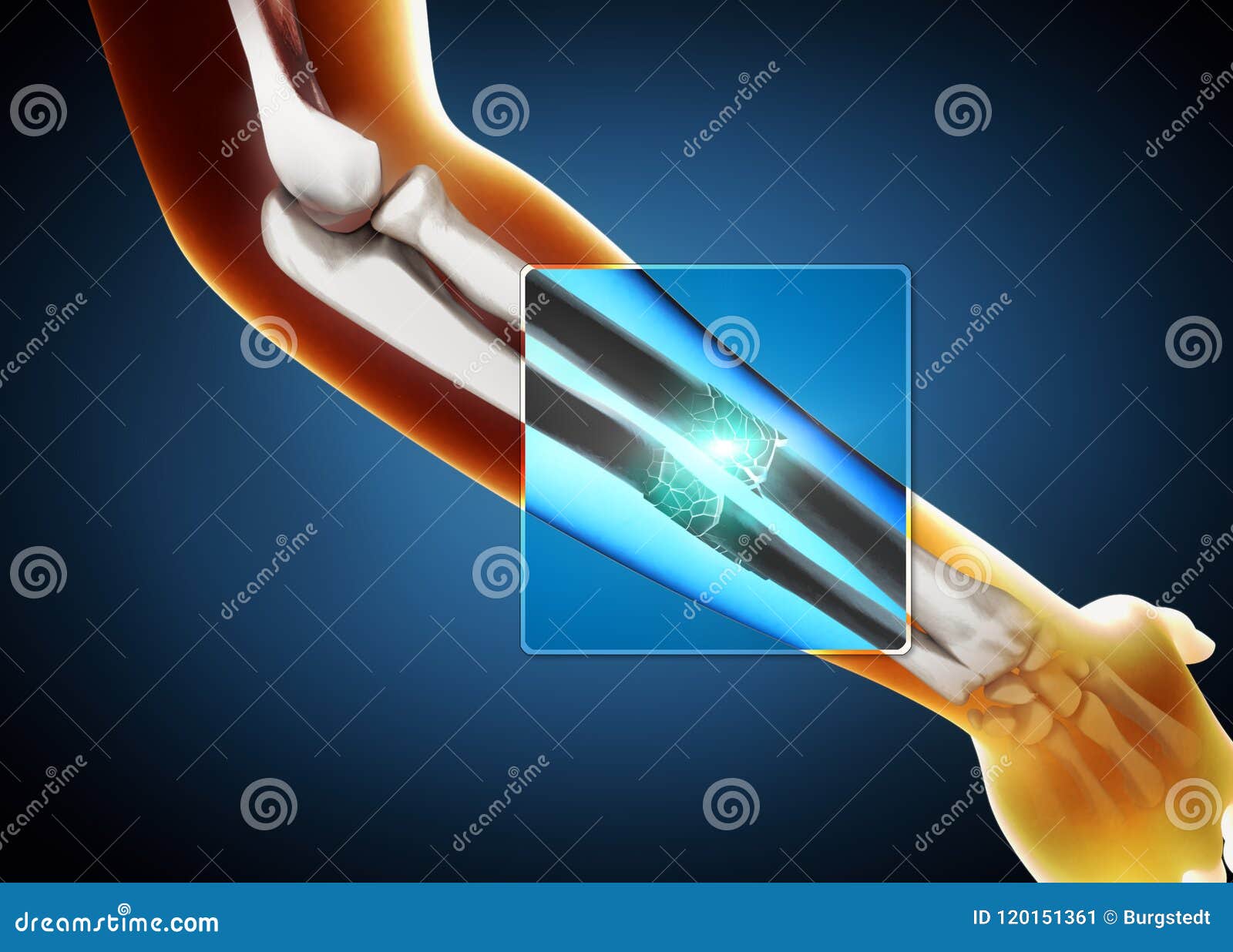 3d Illustration Of A X-ray Image Of A Broken Ulna And Radius Bone ...