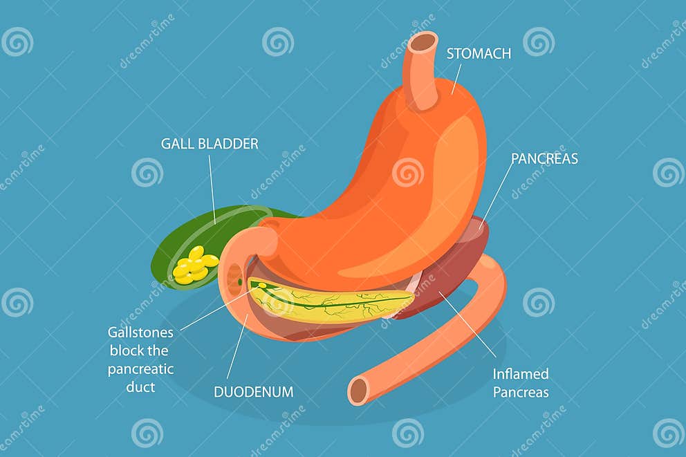 3D Isometric Flat Vector Conceptual Illustration of Acute Pancreatitis ...