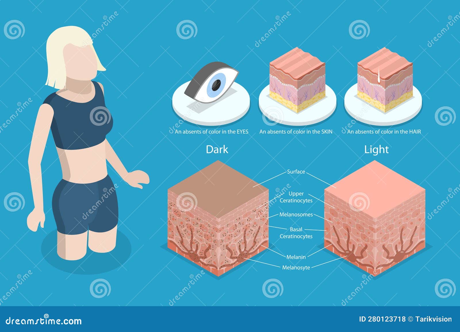 Melasma. Cross Section Of Human Skin With Hyperpigmentation Cartoon ...