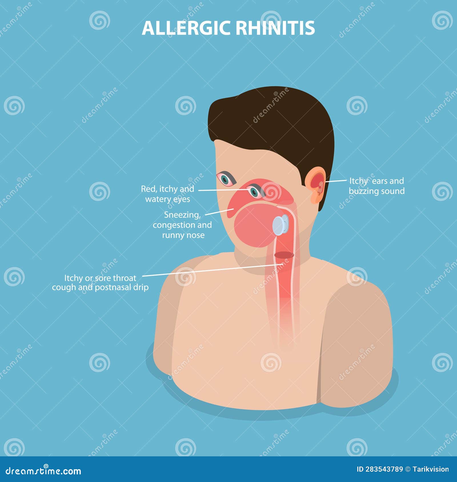 3D Isometric Flat Vector Conceptual Illustration of Allergic Rhinitis ...