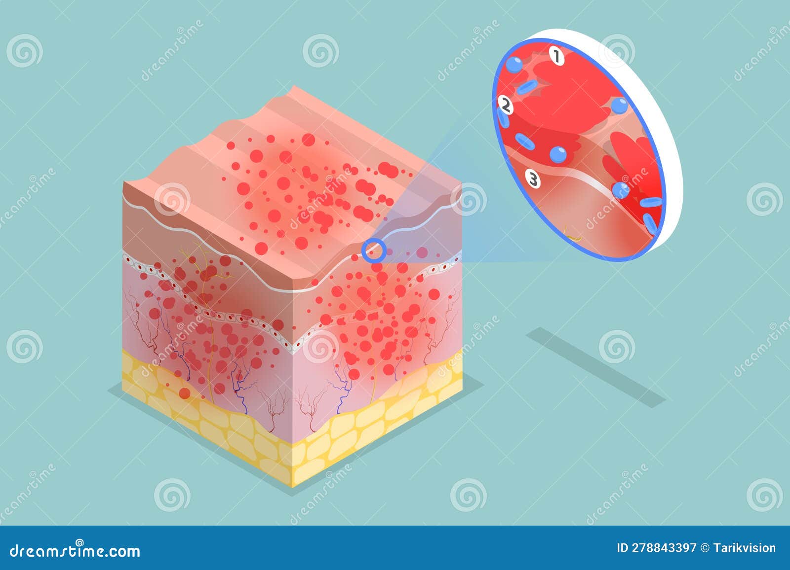 3d Isometric Flat Vector Conceptual Illustration Of Atopic Dermatitis