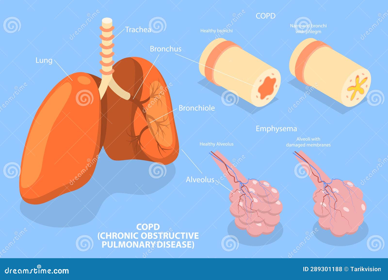 3D Isometric Flat Vector Conceptual Illustration of COPD Stock Vector ...