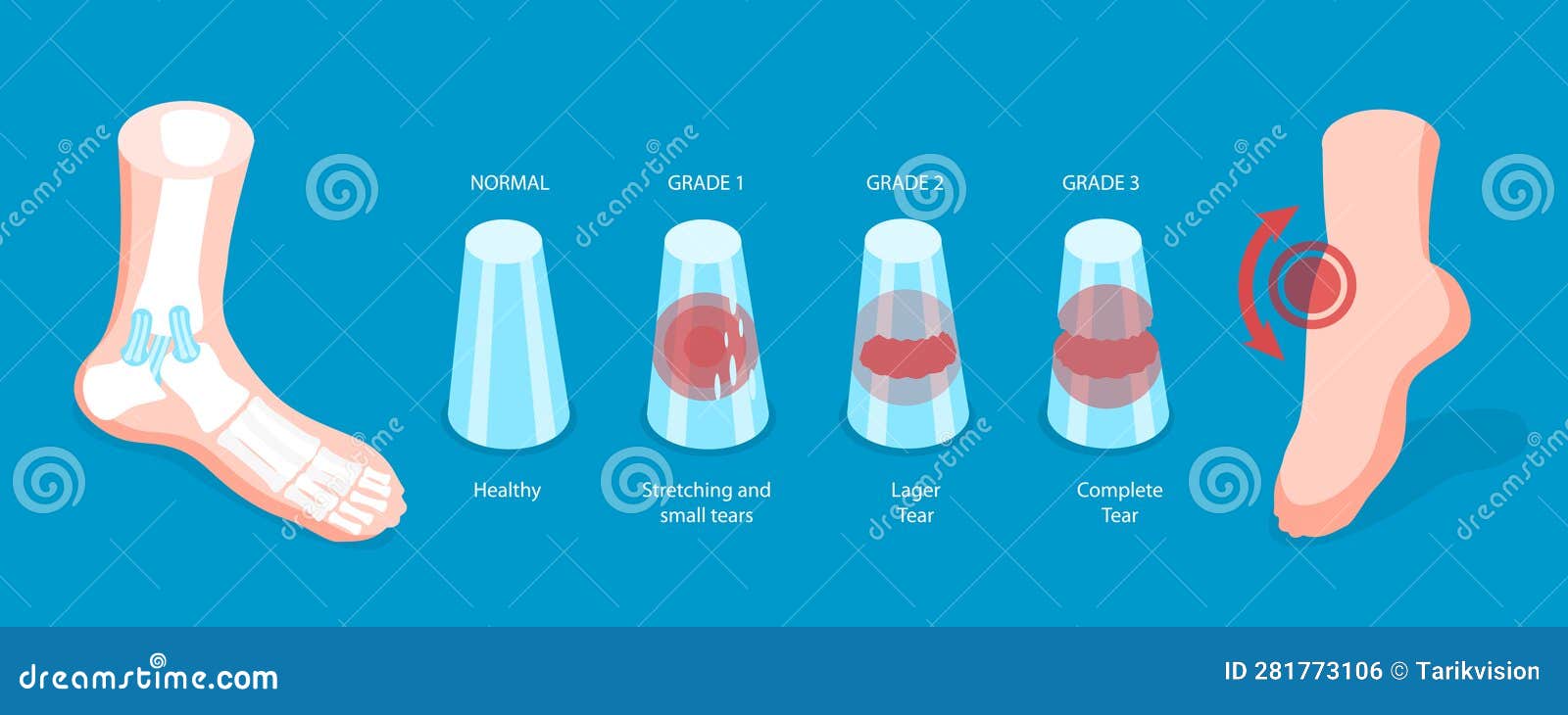 3D Isometric Flat Vector Conceptual Illustration of Grades of Sprain ...