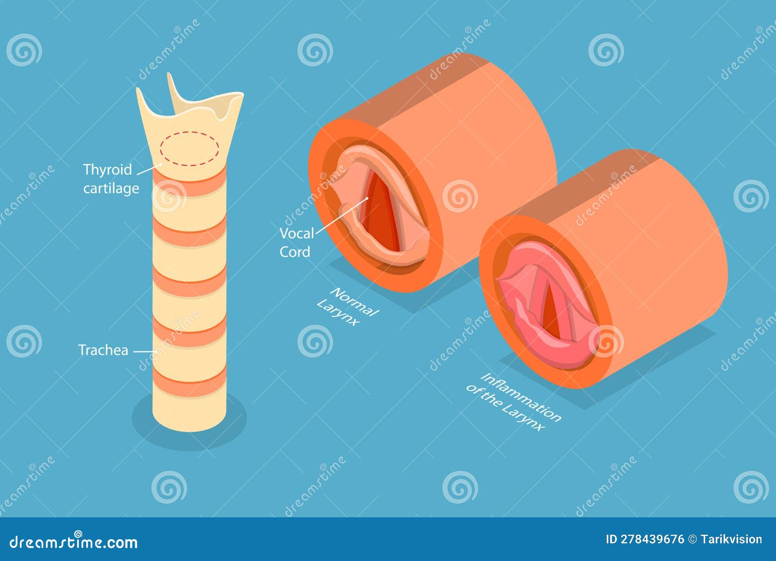 3D Isometric Flat Vector Conceptual Illustration of Laryngitis Stock ...