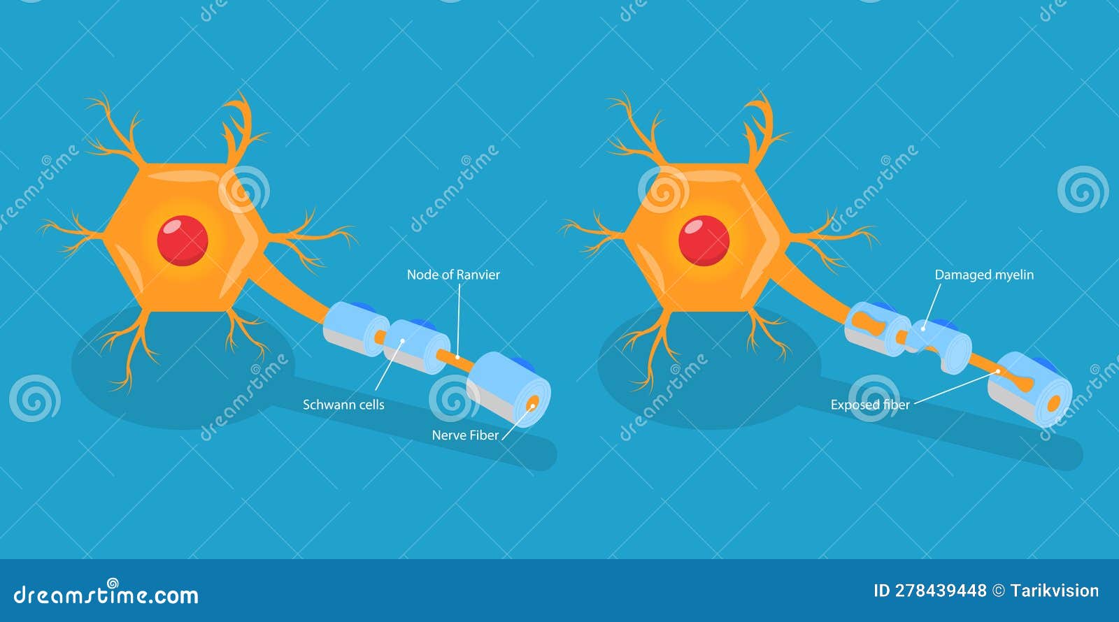 3D Isometric Flat Vector Conceptual Illustration of Multiple Sclerosis ...